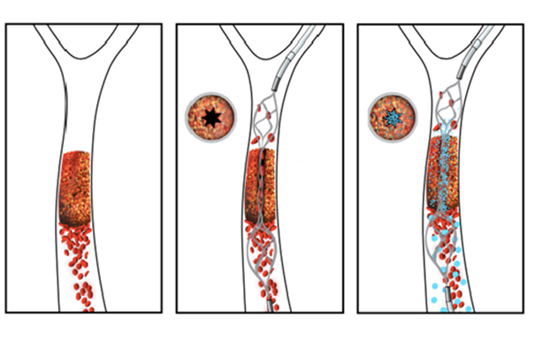 Blood clot breakthrough uses drug-device combo — Harvard Gazette