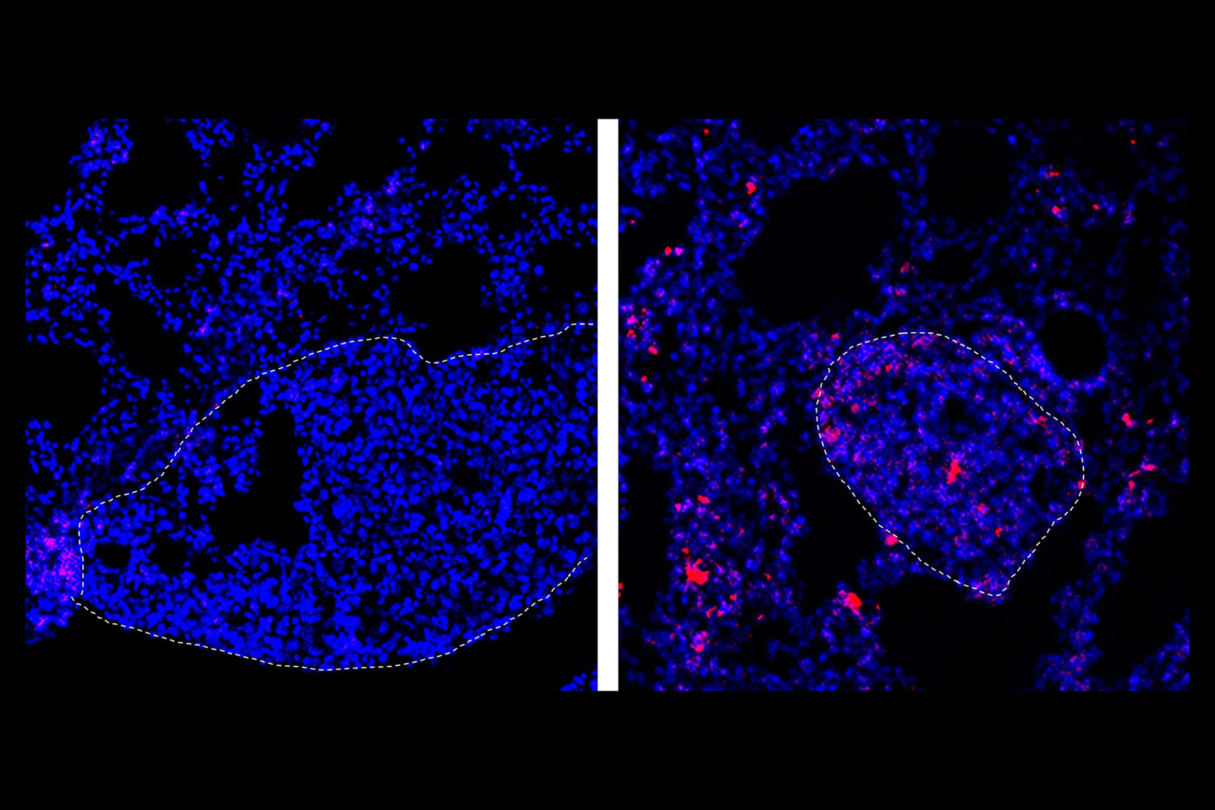 Better delivery system for sending chemo to cancerous lung tissue ...