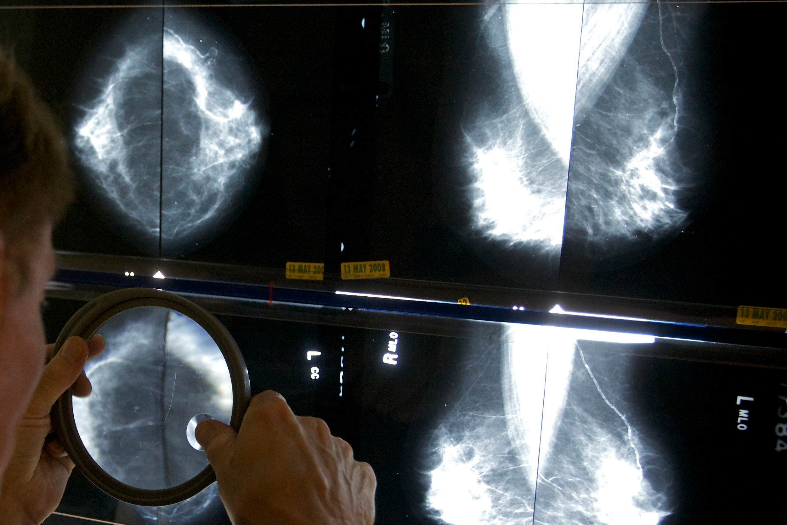 Why start mammograms at 40? Doctor explains new advice. — Harvard Gazette